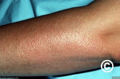 Itchy arms no rash store