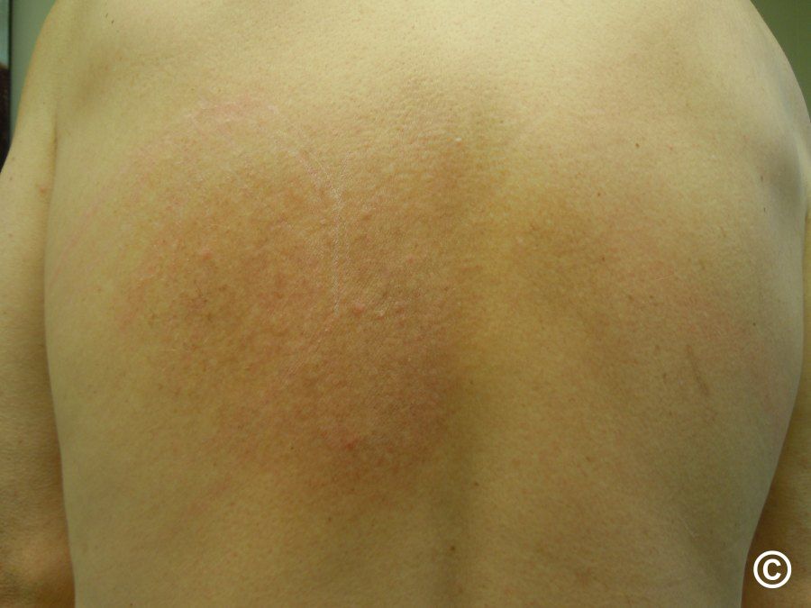 Notalgia Paresthetica Treatment