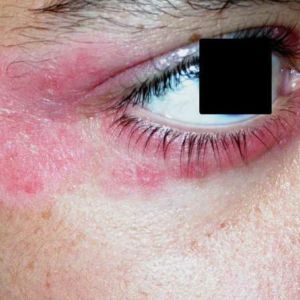 Psoriasis: facial psoriasis