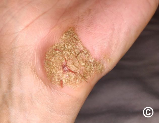 Hyperkeratosis