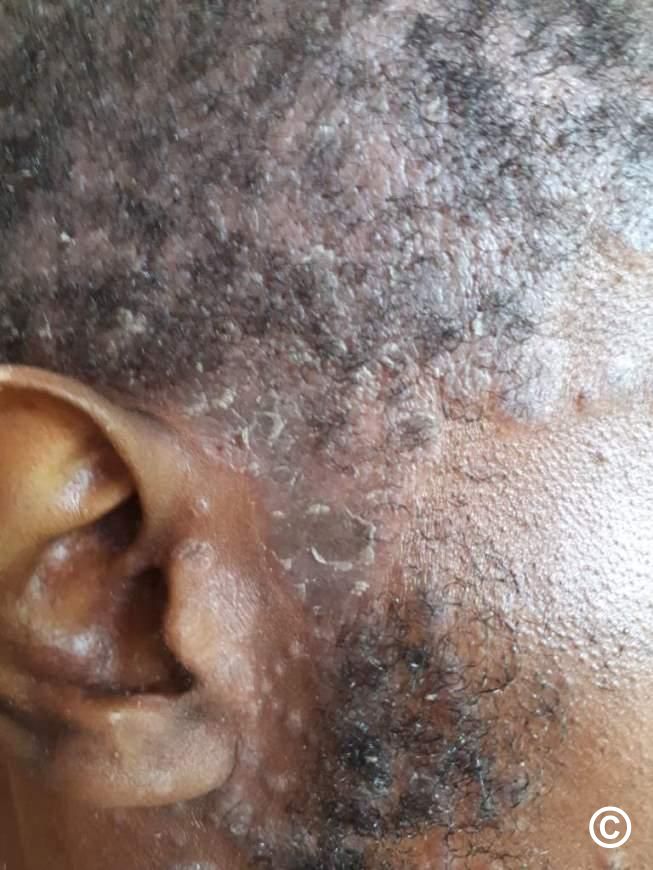 Psoriasis: scalp psoriasis