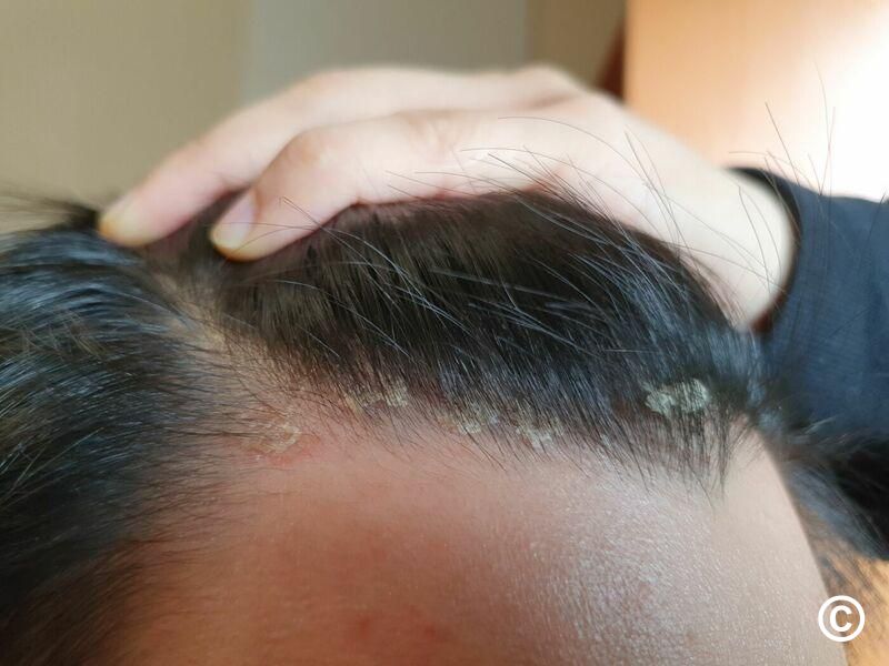 Psoriasis: scalp psoriasis