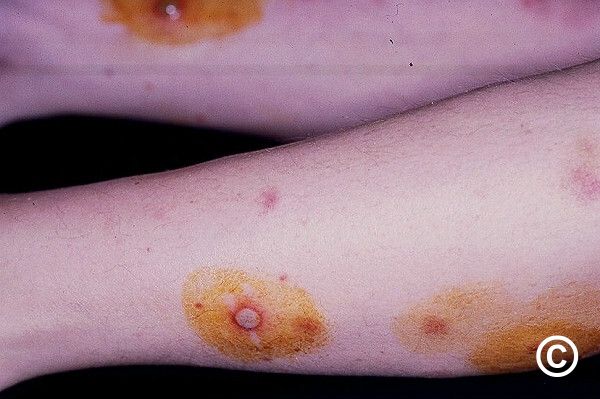 Pyoderma Gangrenosum