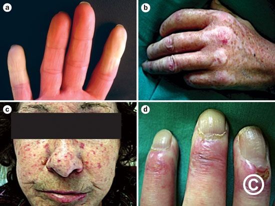 Raynaud's phenomenon