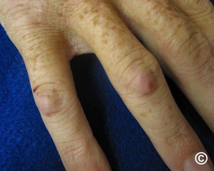 Rheumatoid Arthritis Nodules On Fingers