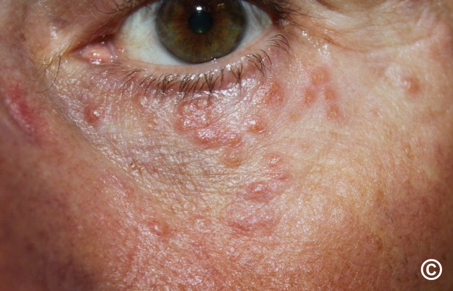 Granulomatous Rosacea Histology