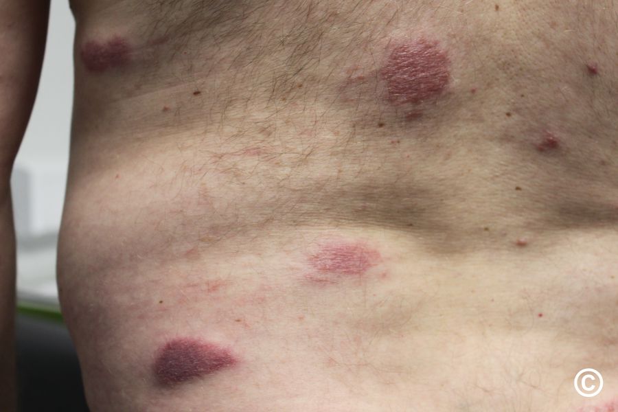 Sarcoidosis Rash