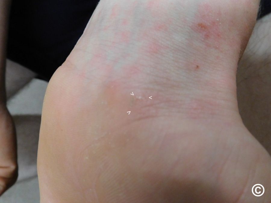 Scabies On Foot Deals