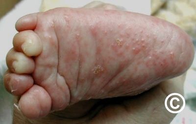 Mild Scabies On Feet