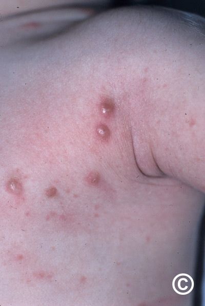 Nodular Scabies Scrotum Rashes That Look Like Scabies: Causes,