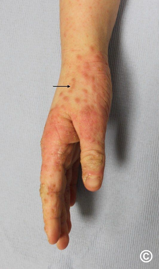 Scabies Rash On Hands Scabies: Diagnosis And Treatment With Images