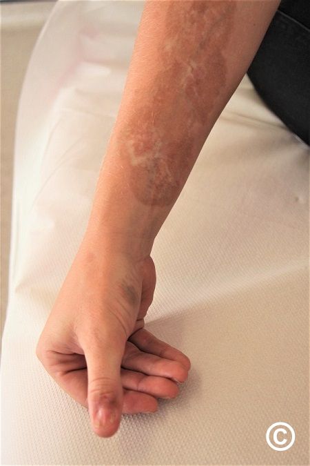 Esclerodermia Linear Residência Pediátrica Esclerodermia