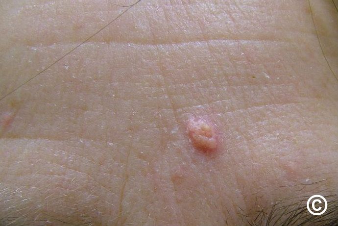 Sebaceous adenoma and sebaceomas