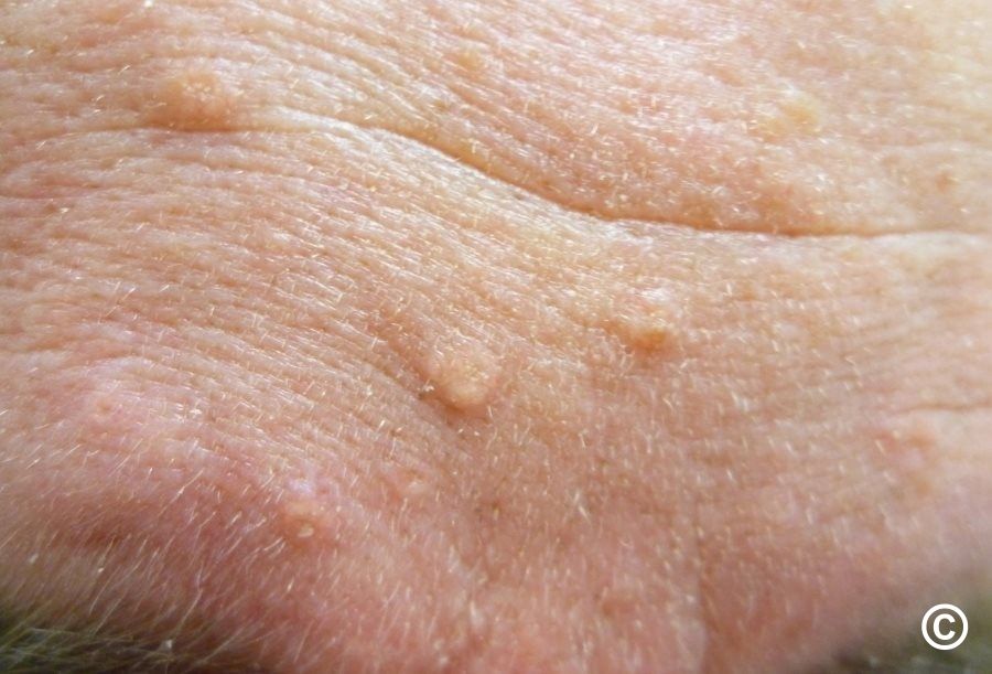 Sebaceous Hyperplasia