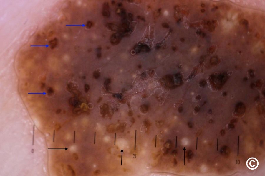 Seborrheic Keratosis Dermoscopy