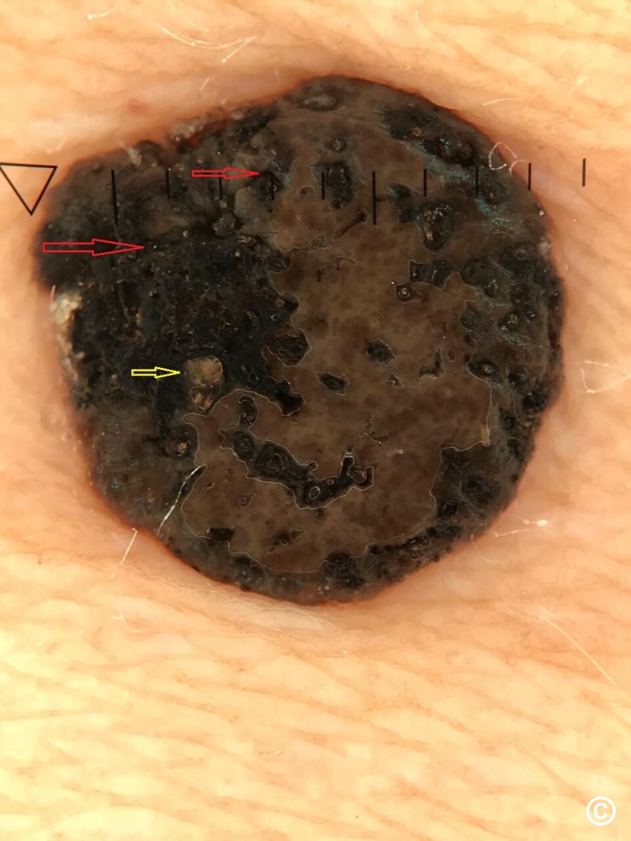Seborrheic Keratosis Dermoscopy