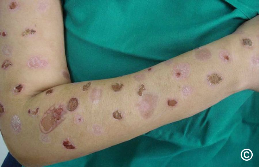 Eraser Burn Self Harm