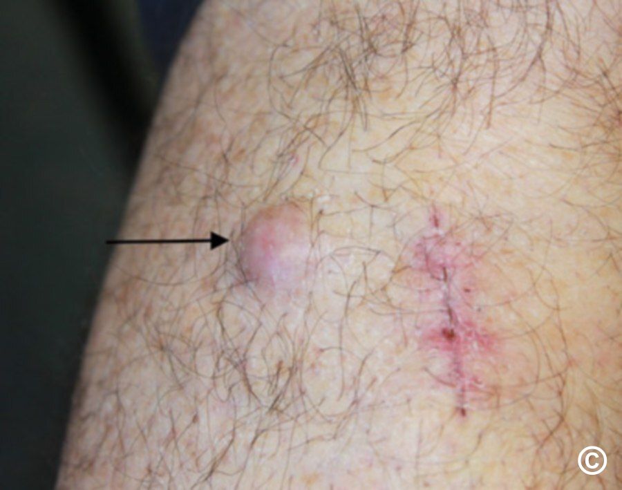 Cutaneous metastases