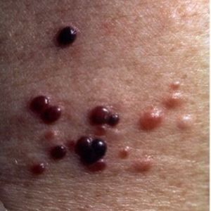 Cutaneous metastases