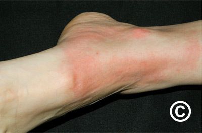 Solar Urticaria Dealing With Sun Allergy? Know The Causes, Symptoms