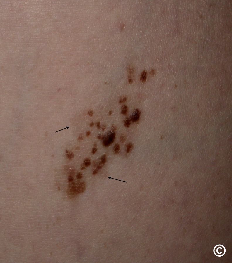 Speckled lentiginous naevus (syn. naevus spilus)
