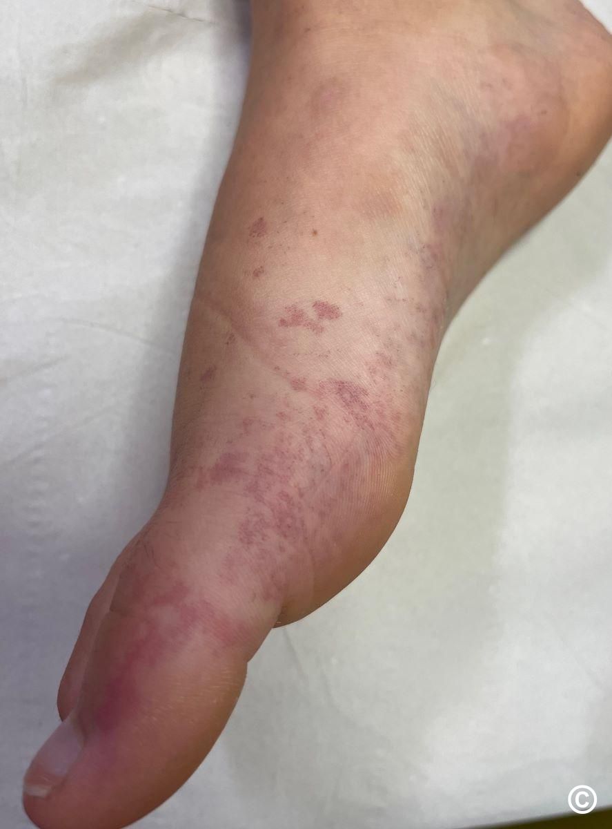 Spider Telangiectasia Liver