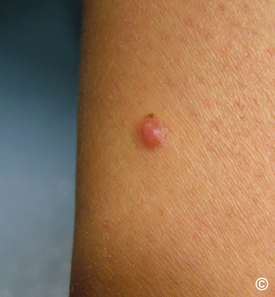 Spindle Cell Nevus Pathology Outlines at Rita Eustice blog