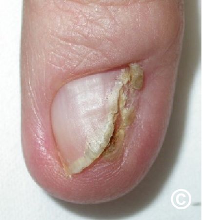 Squamous cell carcinoma