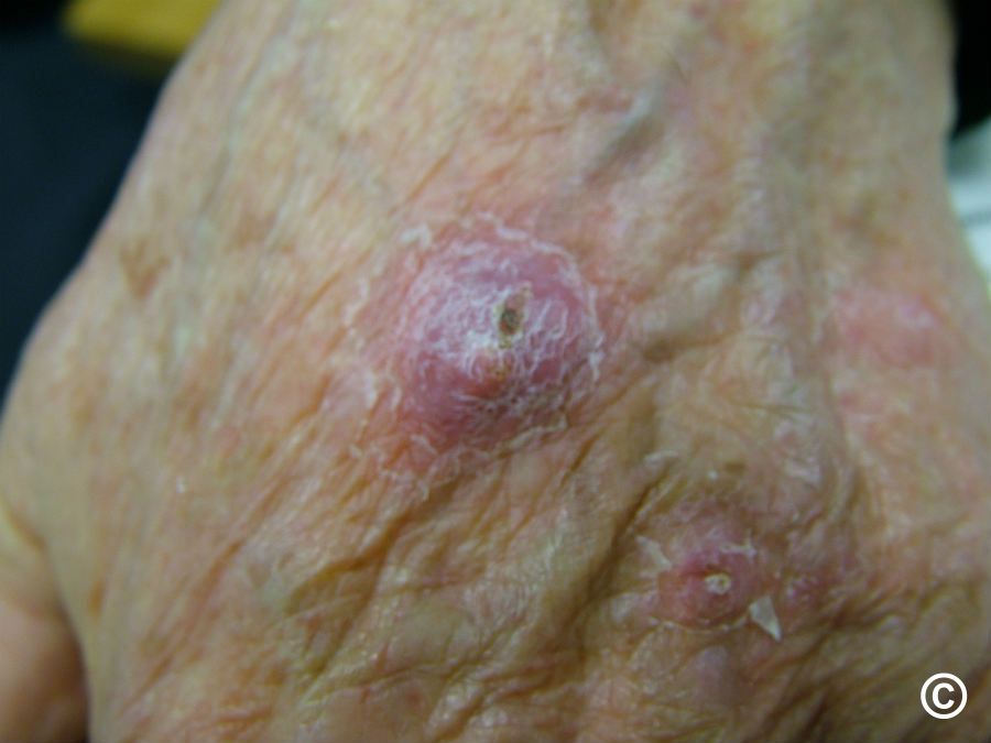 Squamous cell carcinoma