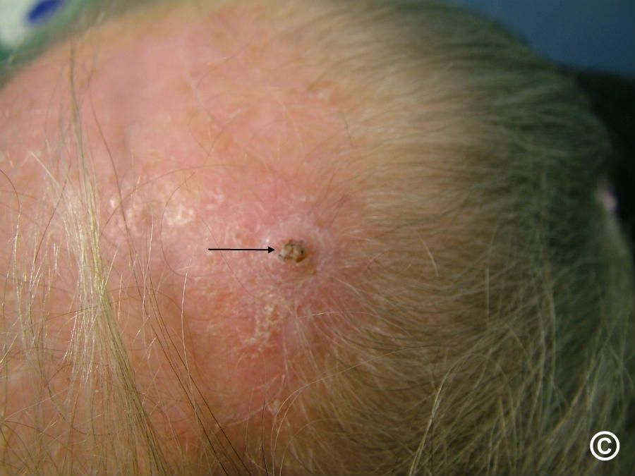 Early Squamous Cell Carcinoma Scalp