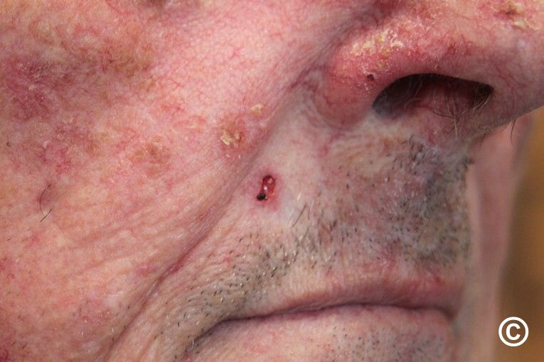 Squamous cell carcinoma