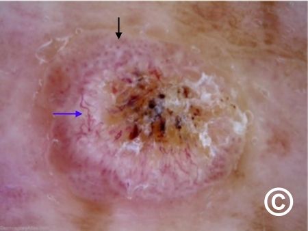 Squamous cell carcinoma