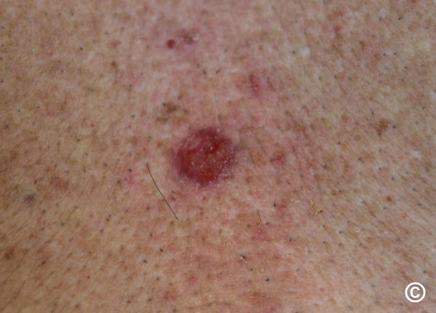 Squamous cell carcinoma