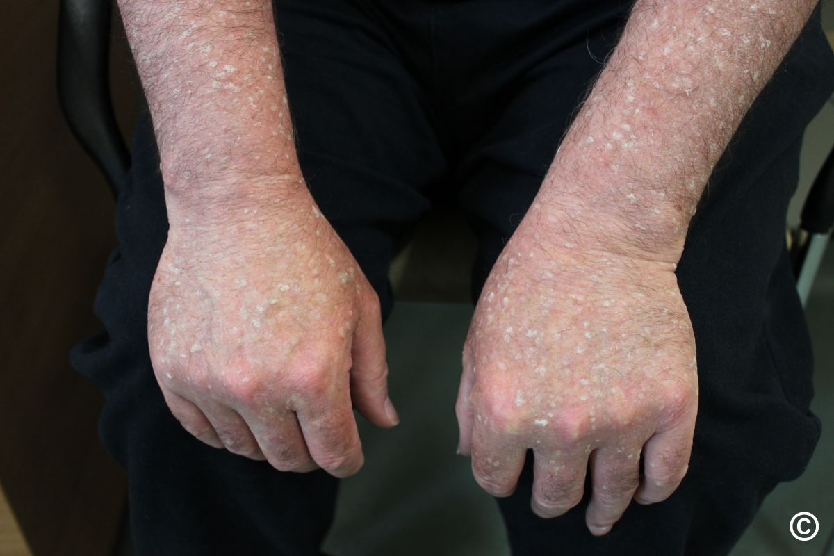 Stucco keratosis