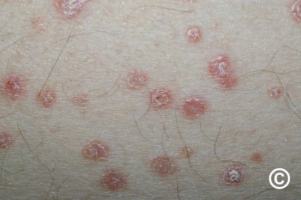 Primary Syphilis Rash
