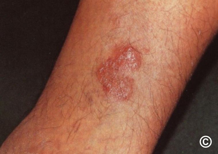 Early Syphilis Chancre.