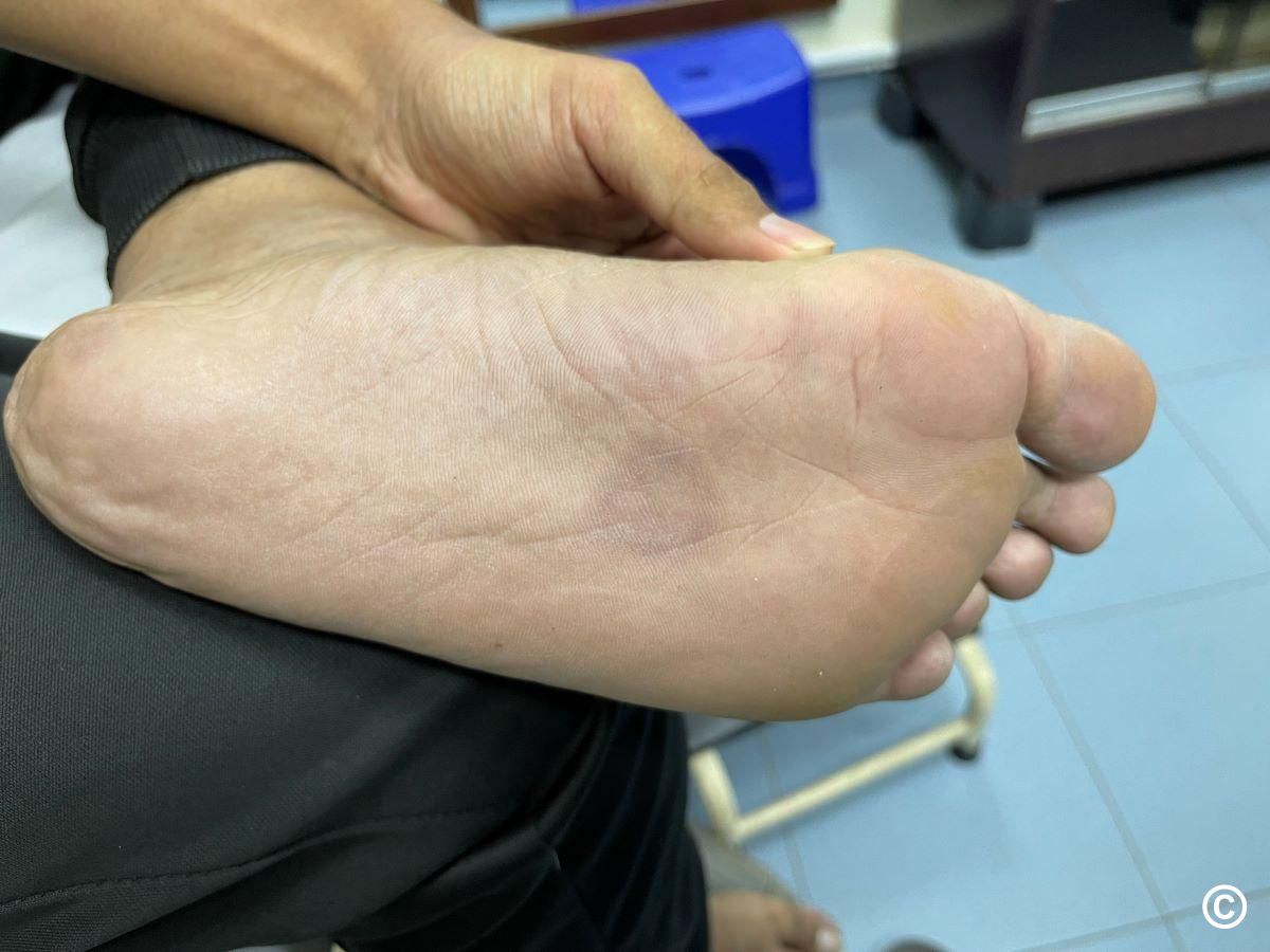 Syphilis Rash On Sole Of Foot Factory Sale | emergencydentistry.com