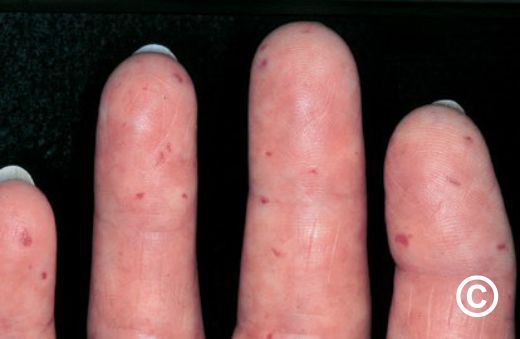 Systemic sclerosis
