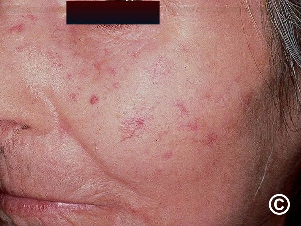 Crest Syndrome Rash DIT Musculoskeletal/Derm (Day 8) Flashcards