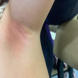 Terra firma-forme dermatosis