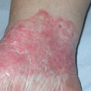 Tinea corporis, cruris, and incognito