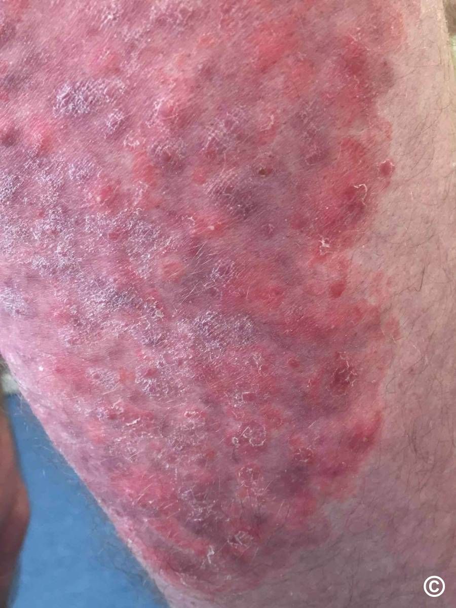 Tinea Corporis Perna