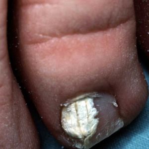 Tinea manuum, pedis and unguium