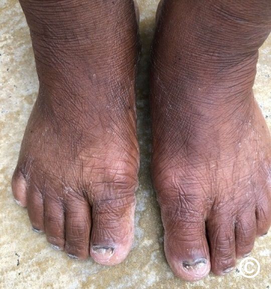 Tinea manuum, pedis and unguium