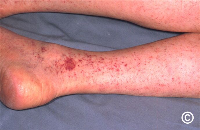 Rocky Mountain Spotted Fever Bacteria Shape