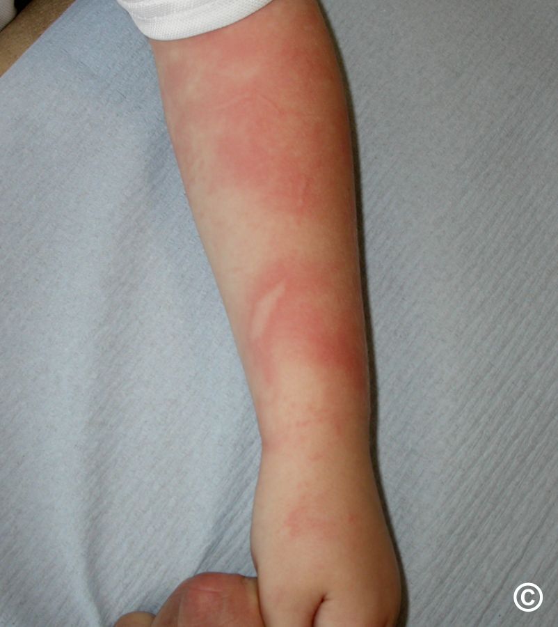 Physical urticaria