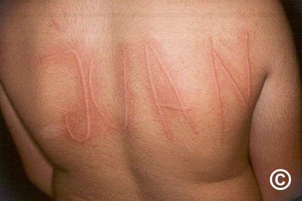 Physical Urticaria