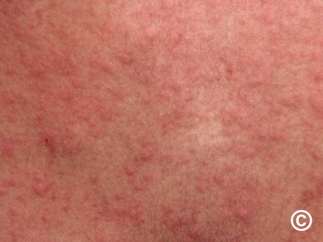 Urticaria Dermatografica