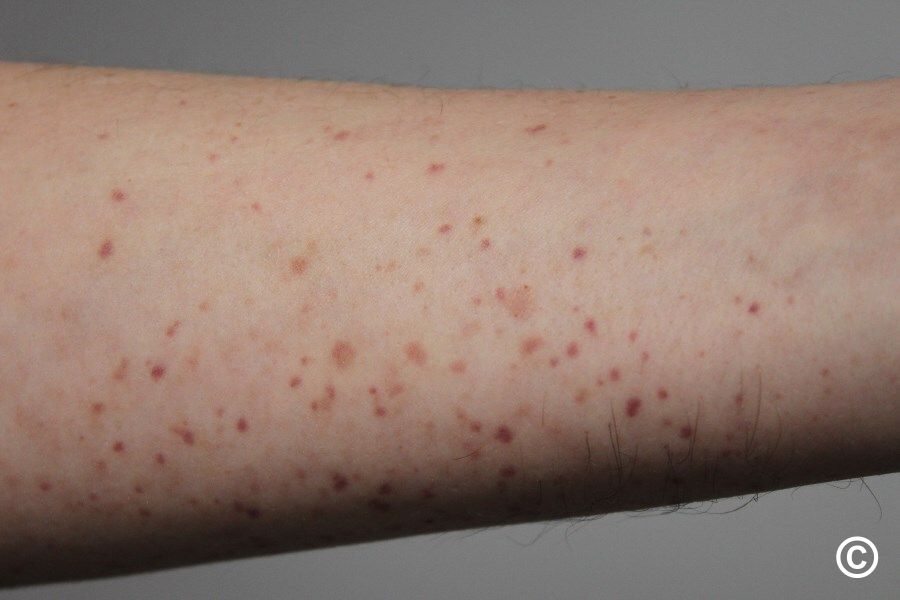 Vasculitis Rash Leukocytoclastic Vasculitis (LCV)