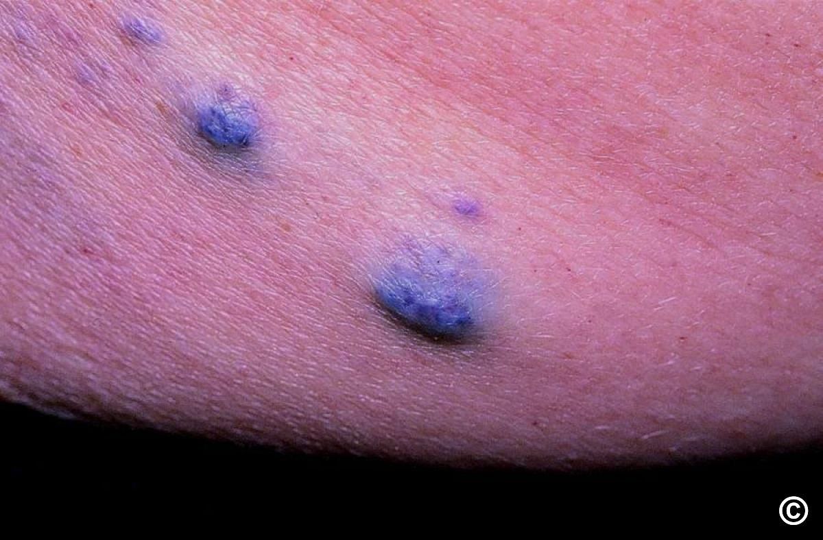 Venous Malformation Arm